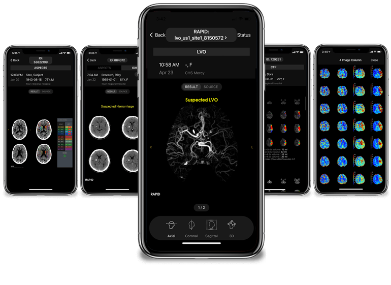Neuroimaging Stroke Software Platform Powered by AI | RapidAI